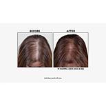 Capillus202 Battery-Operated Laser Hair Therapy Cap | HSN